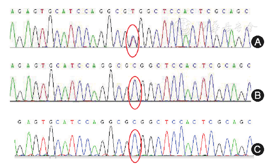 ADCY5基因突变致家族性运动障碍面部肌纤维颤搐症一例