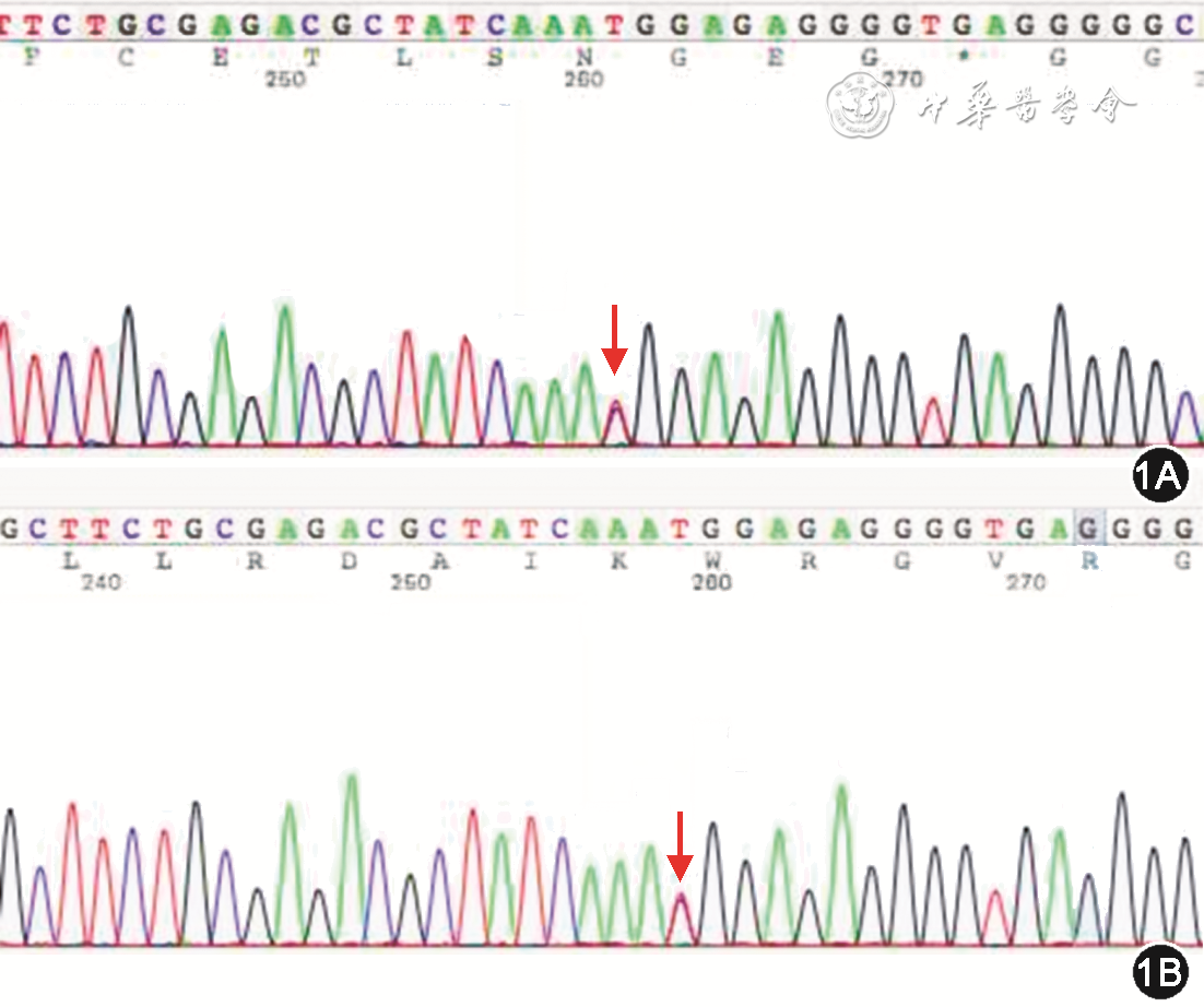 GCK-MODY孕期个体化治疗和血糖波动特征分析1例