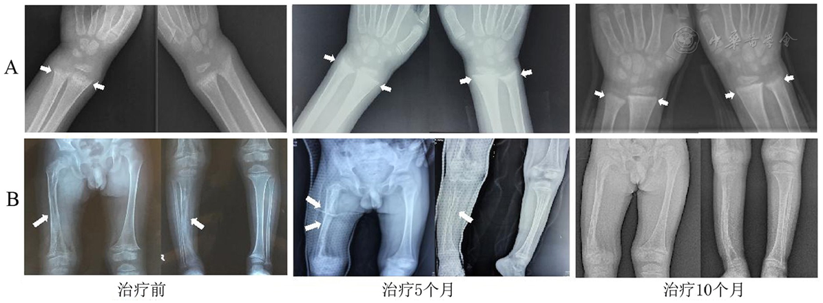 一例罕见的McCune-Albright综合征合并低血磷性佝偻病