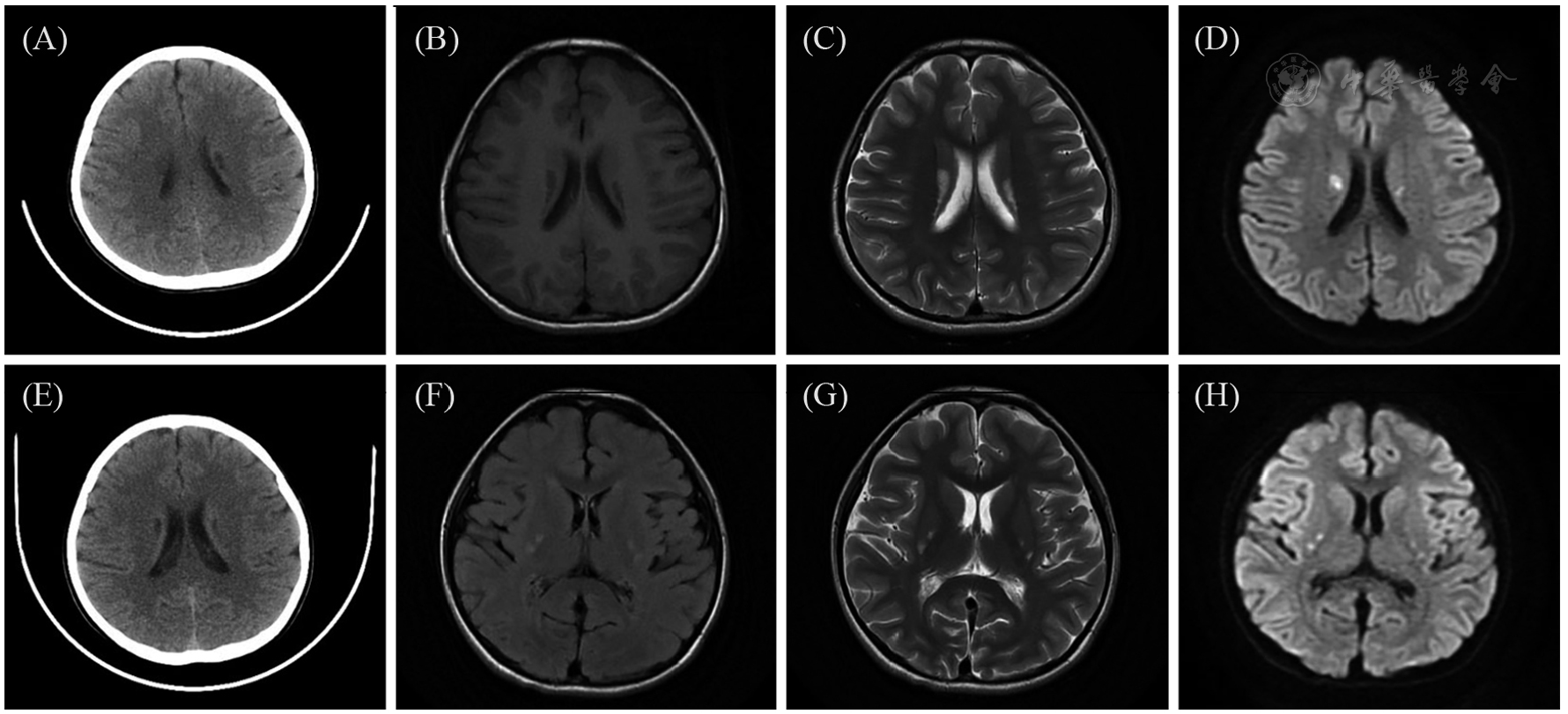 MT-TL1基因m.3252A>G变异致MELAS综合征一例并文献复习