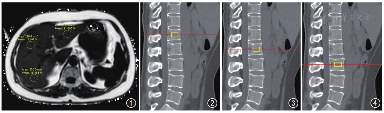 中老年人群肝脏脂肪含量与骨密度的相关性研究