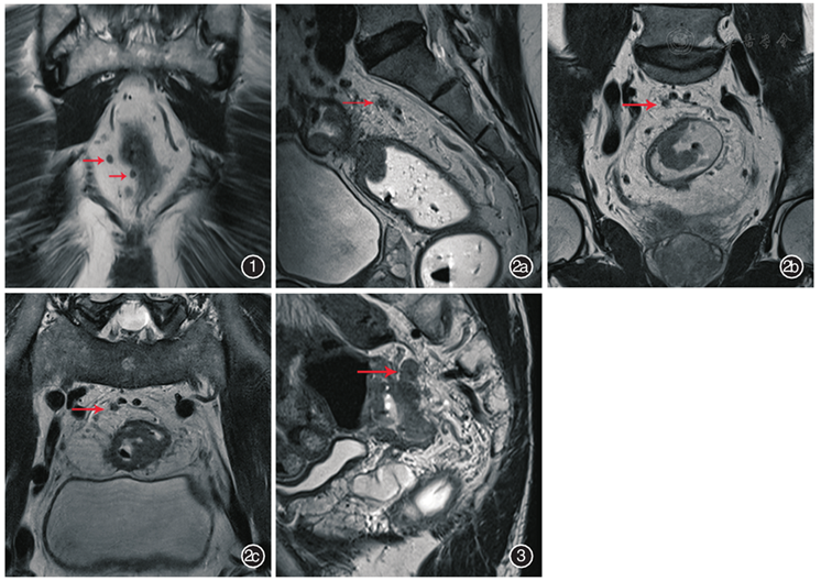 3.0T高分辨MRI诊断直肠癌直肠系膜淋巴结转移的应用价值