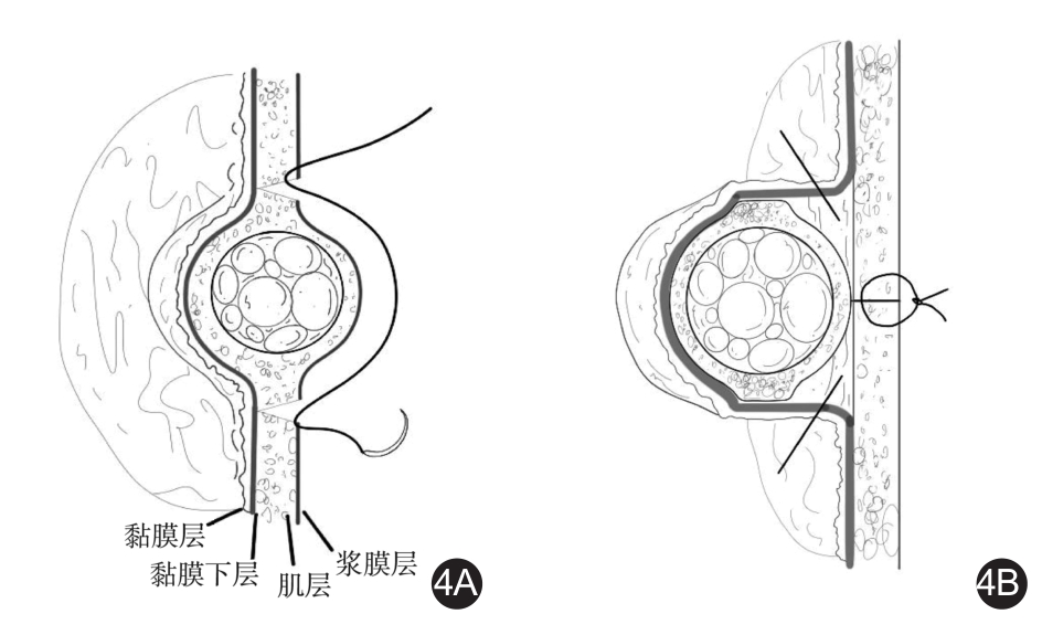 腹腔镜联合内镜治疗胃部肿瘤