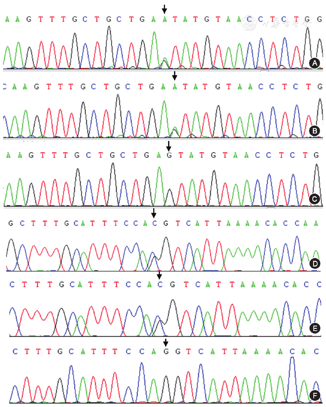HADH基因突变致先天性高胰岛素血症一例临床分析暨文献复习